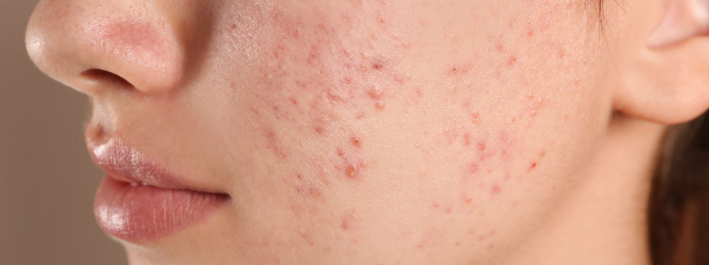 The Ultimate Guide to Omega-3's + 6's for Healthy Skin (Fish Oil +)