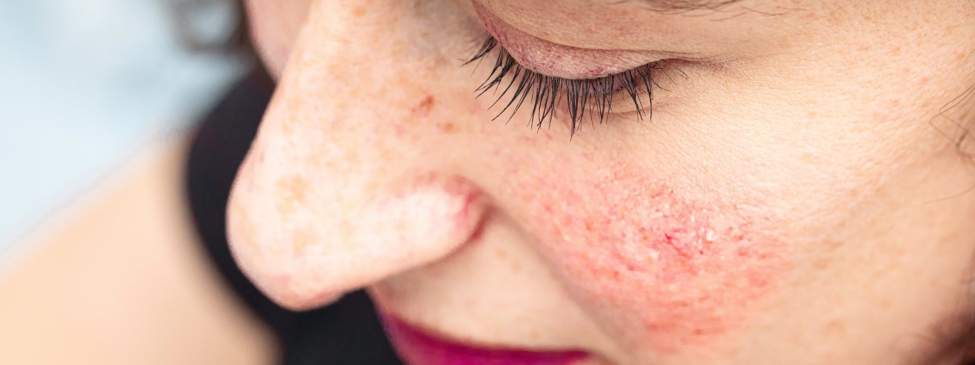 Rosacea - Causes, Triggers & What You Can Do About It