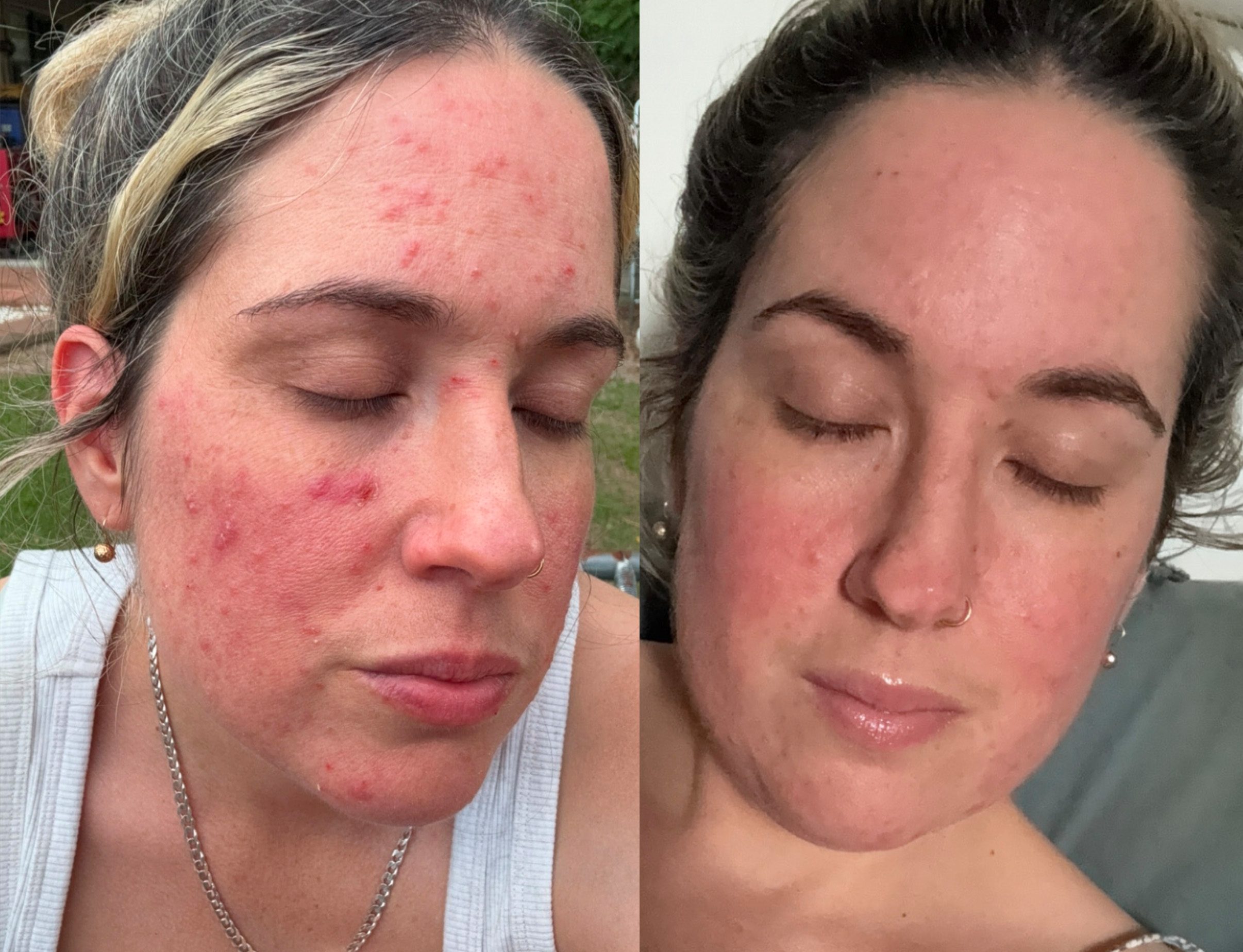 Meet Lilly - "I thought I’d have to live with acne for the rest of my life"